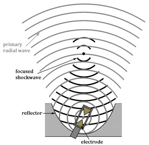 Physical principles of ESWT | ISMST